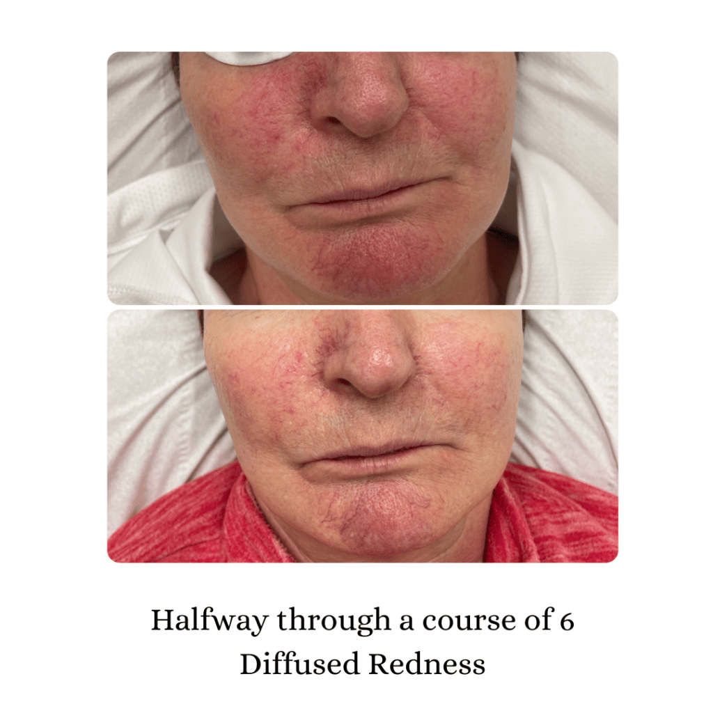 Laser Skin Treatments - Diffused Redness on Face , Neck & Chest - The ...