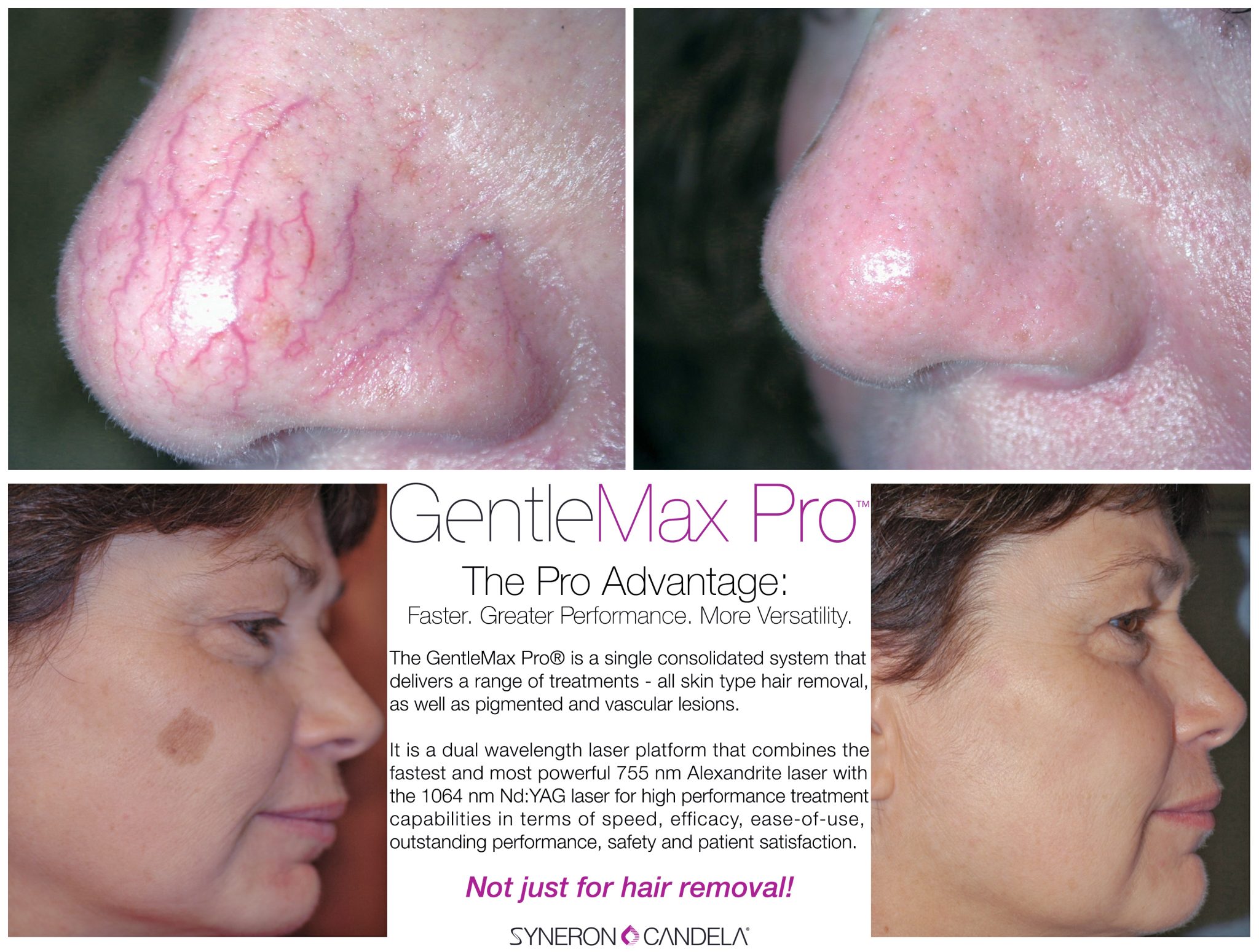 Laser Skin Treatment - Laser Thread Vein Removal Face - The Hair ...